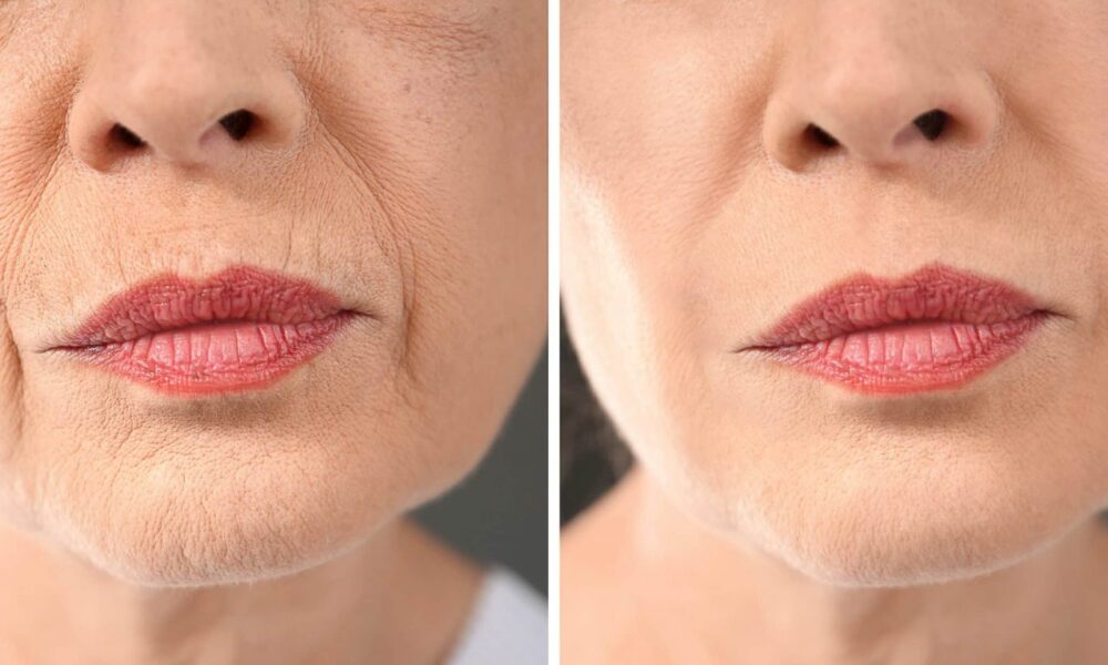 Harmless Skin Rejuvenation with Profhilo Filler - Vdio Magazine 2024